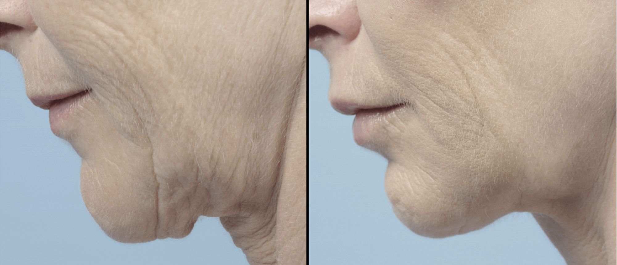 Enhance Skin Tightening and Fat Reduction with FaceTite in La Jolla, CA ...